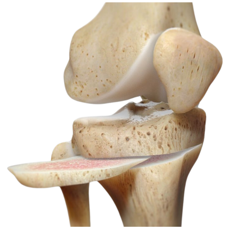 High Tibial Osteotomy for Osteoarthritis: Delay Knee Replacement